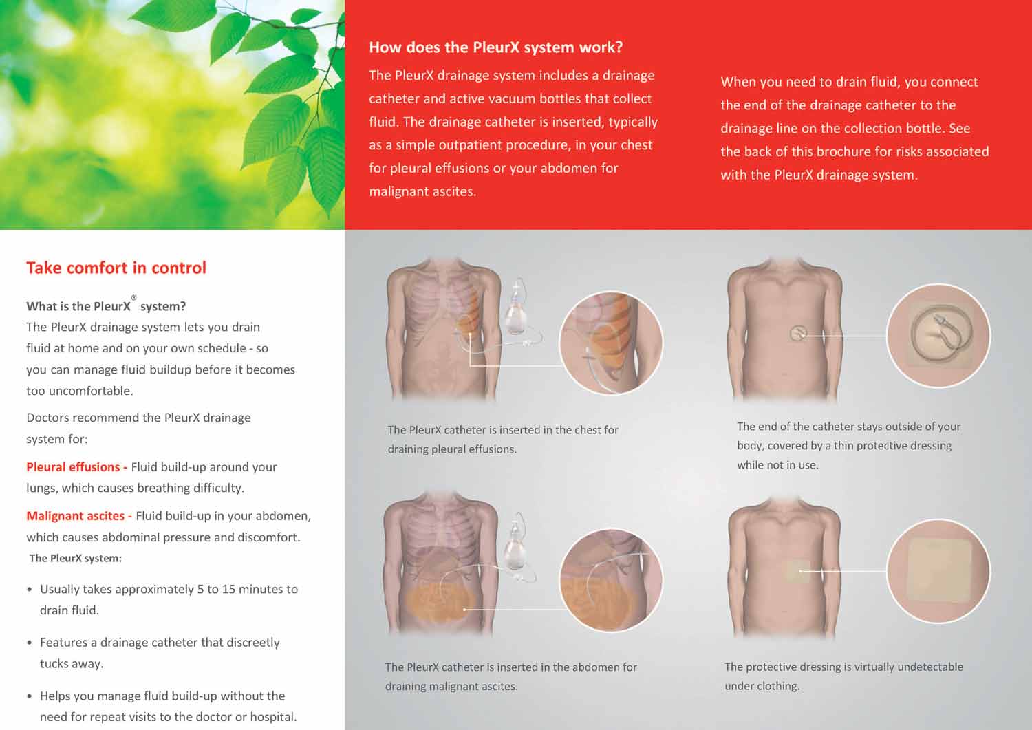 PleurX® Drainage System – Iskus Health